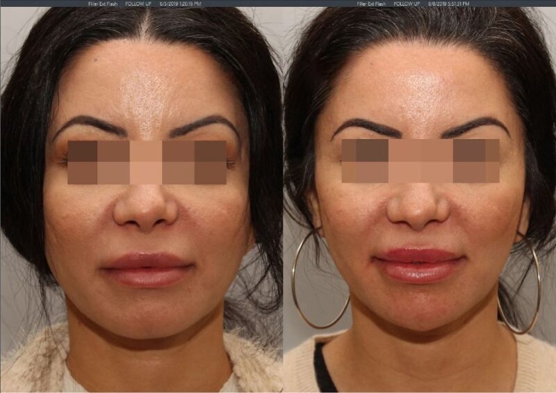 Botox Gallery Focusing on The Masseters (Face Shaping and Sliming))