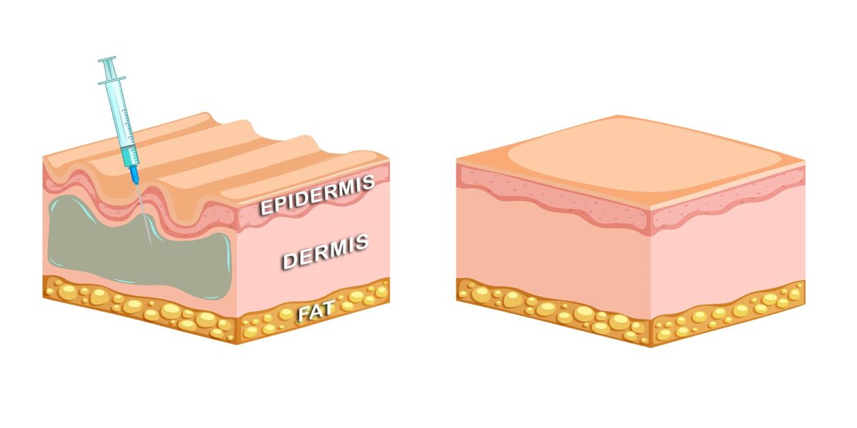 What are dermal fillers? - Lumier Medical
